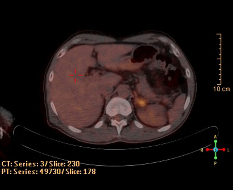 New study evaluates efficacy of pet imaging to manage chronic liver ...